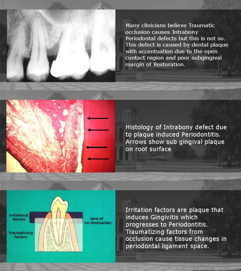 Traumatic Occlusion | Mouth | Periodontology