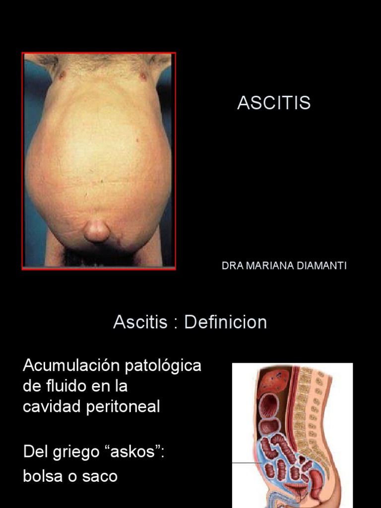 Ascitis | PDF | Especialidades Medicas | Medicina CLINICA