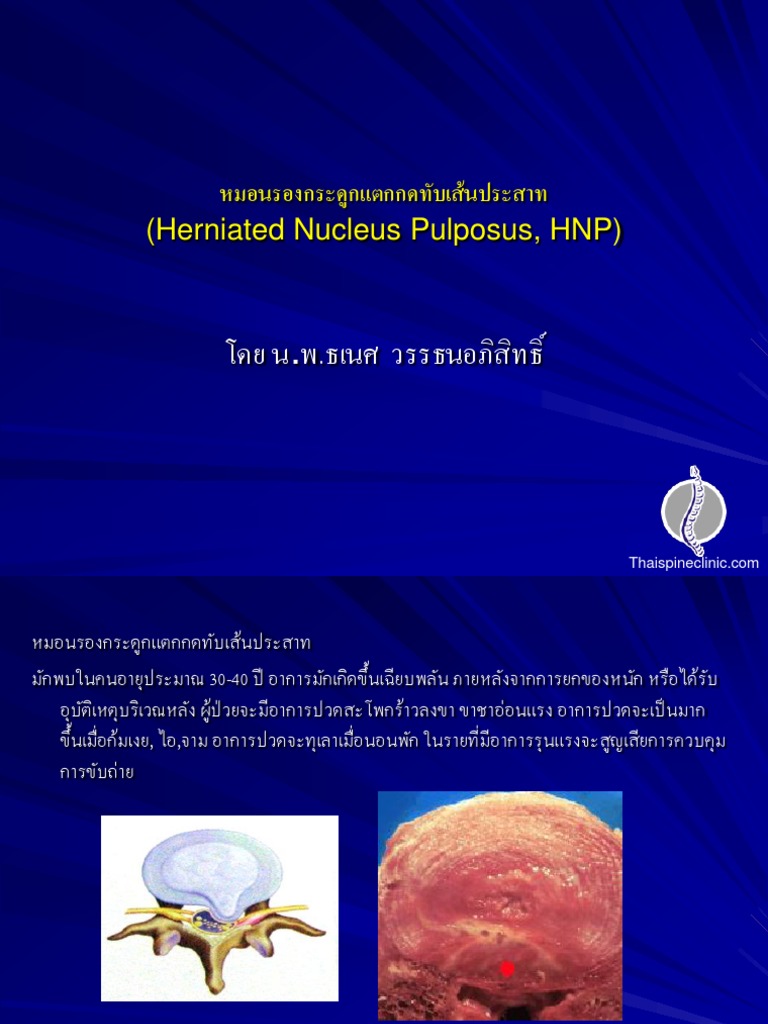 หมอนรองกระดูกแตกกดทับเส้นประสาท (Herniated Nucleus Pulposus, HNP) | PDF