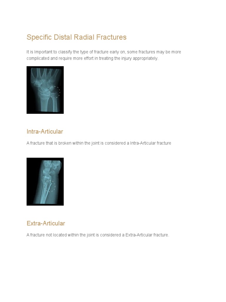 Types of Distal Radial Fractures Explained | PDF