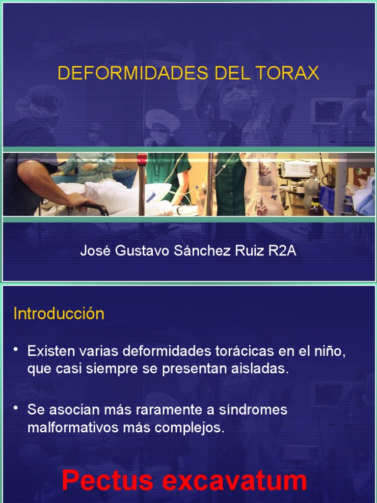 Deformidades torácicas: una revisión de las principales anomalías ...