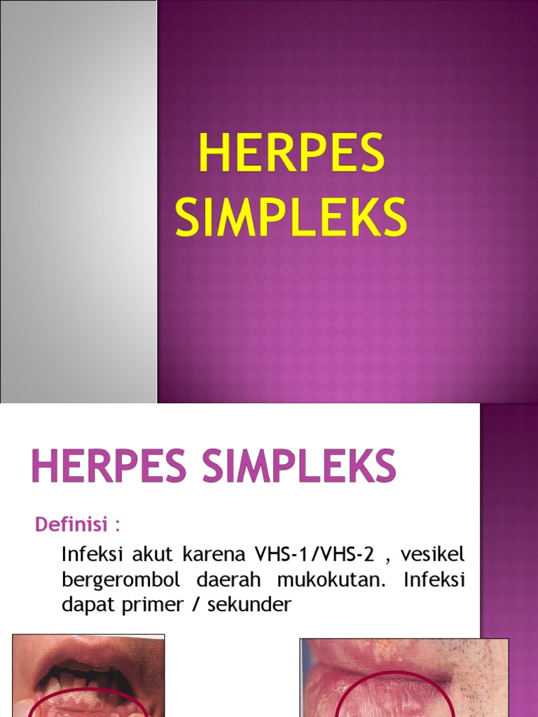 Herpes Simpleks | PDF