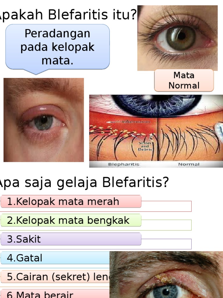 blefaritis
