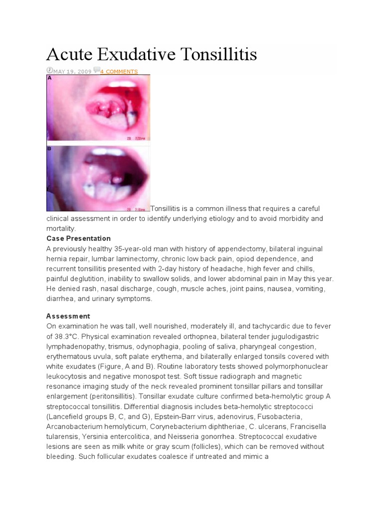 Acute Exudative Tonsillitis | PDF | Immunology | Microbiology