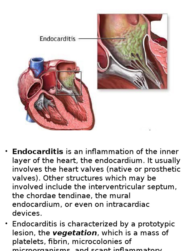 Endocarditis | PDF