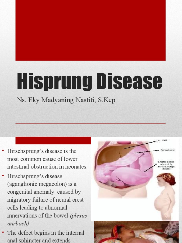 Hirschsprung's Disease in Neonates | PDF | Digestive System | Digestive ...