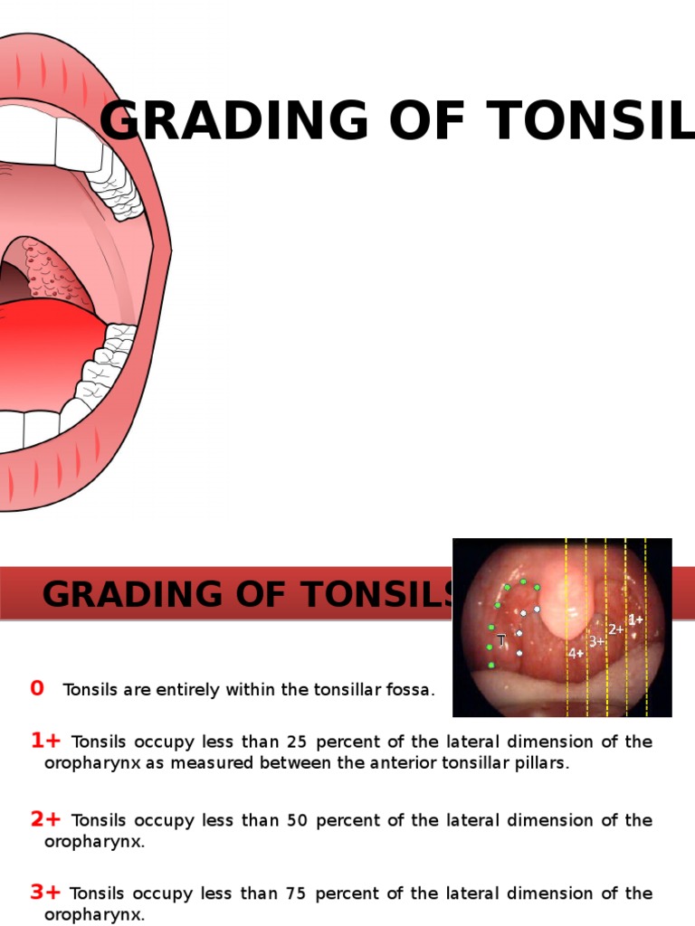 Grading of Tonsil