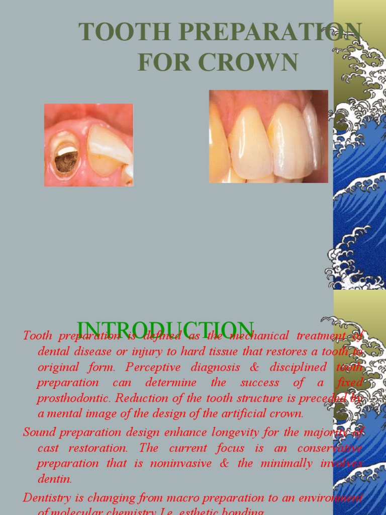 Tooth Preparation For Crown | PDF | Dentistry | Dentistry Branches