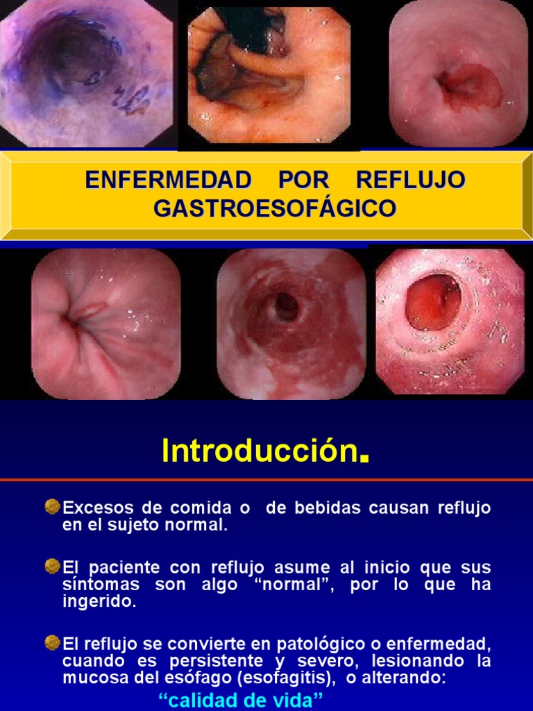 Enfermedad Por Reflujo Gastroesofagico | PDF | La enfermedad por ...