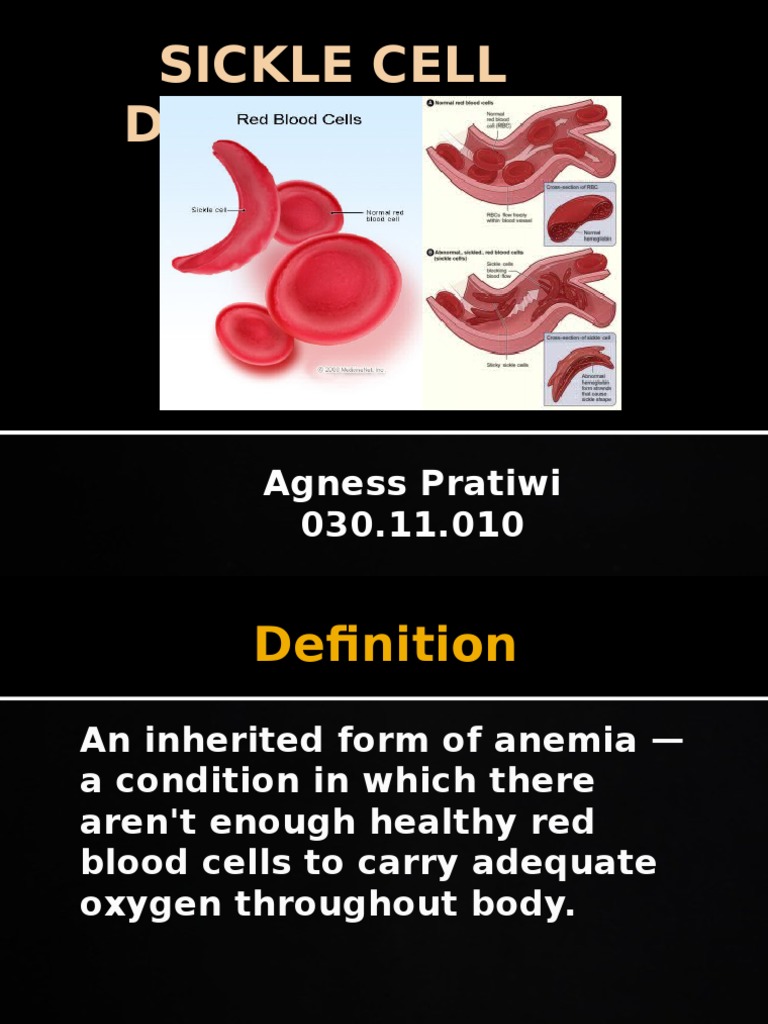 Understanding Sickle Cell Disease | PDF