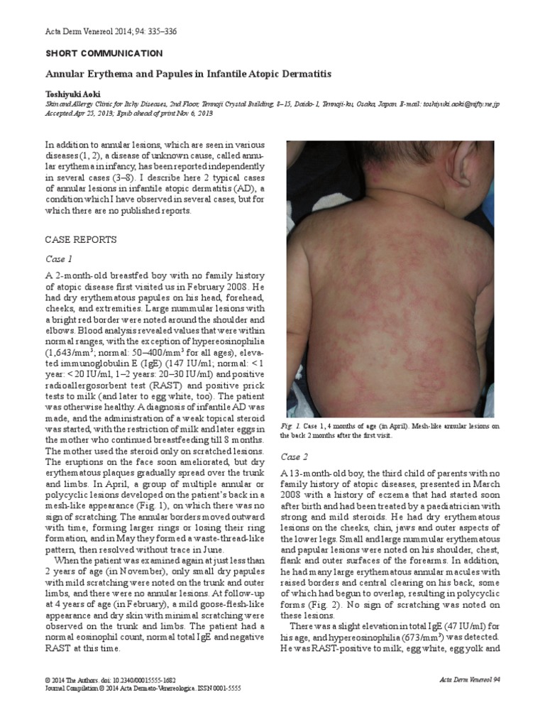 Annular Erythema and Papules in Infantile Atopic Dermatitis: Short ...