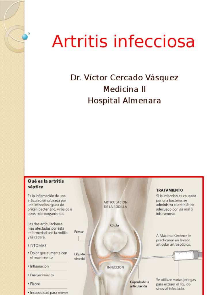 artritis infecciosa | Inflamación | Infección