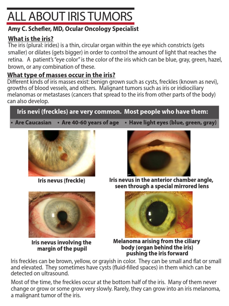 All-About-Iris-Tumors-Dr.-Schefler1.pdf | Metastasis | Melanoma