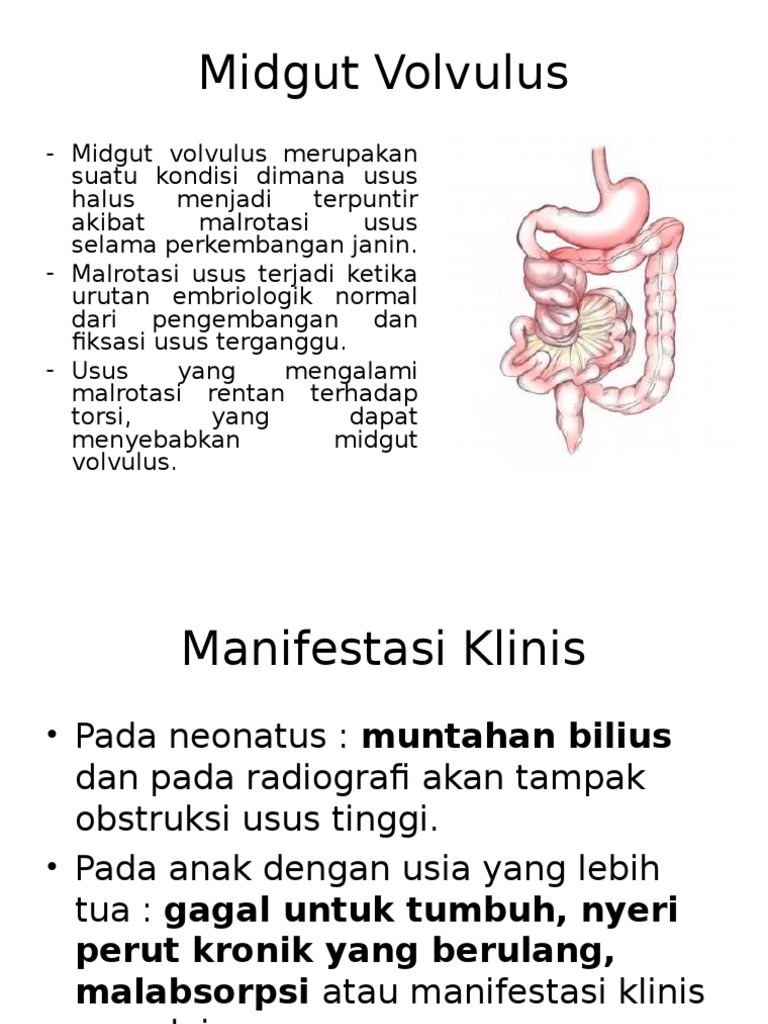Midgut Volvulus: Gejala, Diagnosis, dan Penanganan | PDF