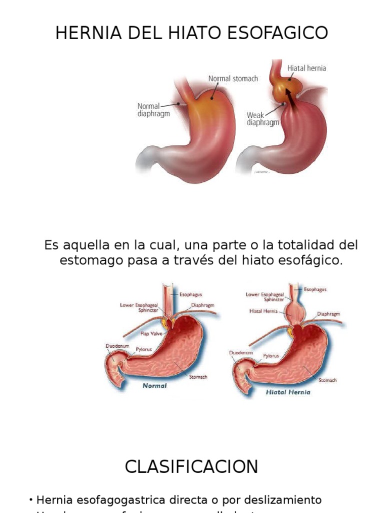 Hernia Del Hiato Esofagico | PDF | La enfermedad por reflujo ...