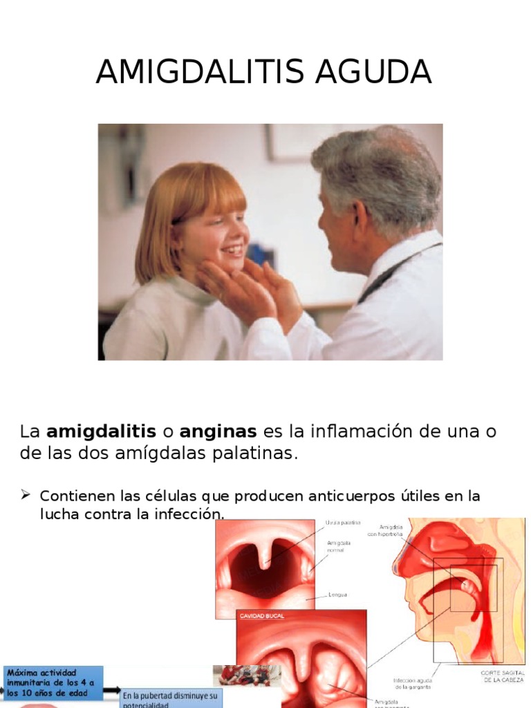 Amigdalitis Aguda y Cronica | PDF | Sistema inmune | Inflamación