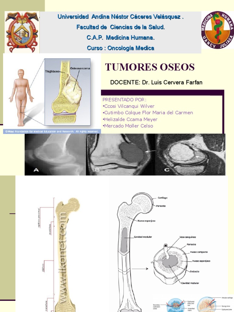 Exposicion Tumores Oseos | PDF | Cáncer | Hueso
