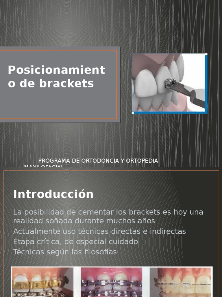 Posicionamiento de Brackets | PDF | Ortodoncia | Diente