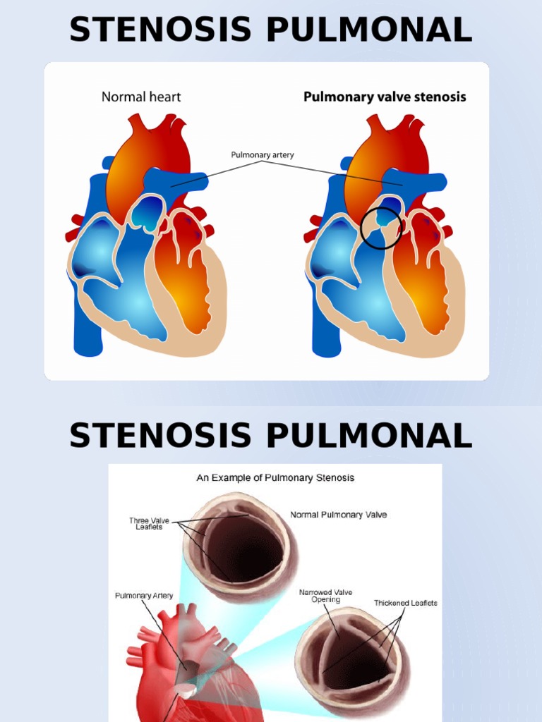 Stenosis Pulmonal | PDF