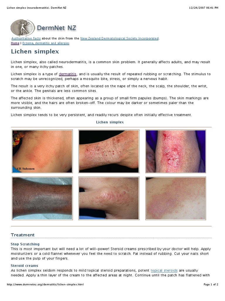 Lichen Simplex / Neurodermatitis | PDF | Dermatitis | Dermatology