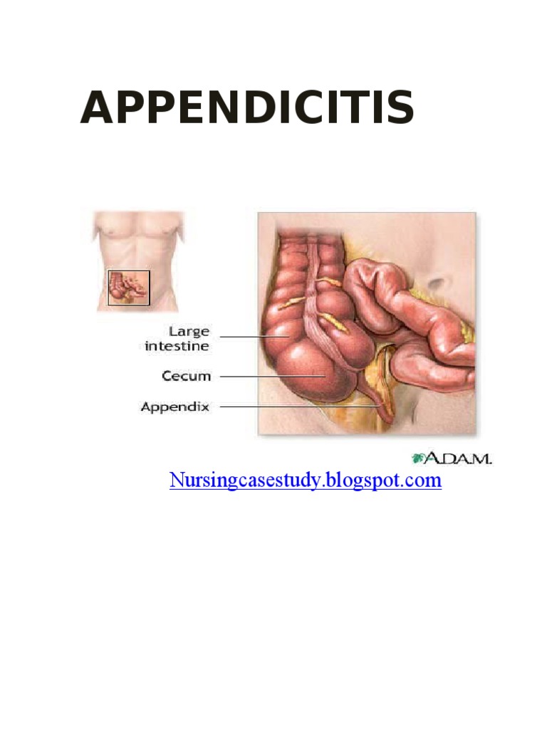 Case Study Appendectomy | PDF | Surgery | Abdomen