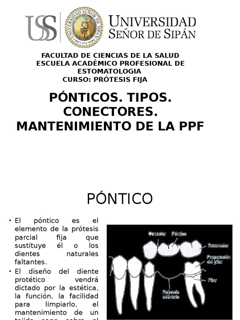 Tipos de Pónticos Dentales en Prótesis | PDF | Dentadura postiza ...
