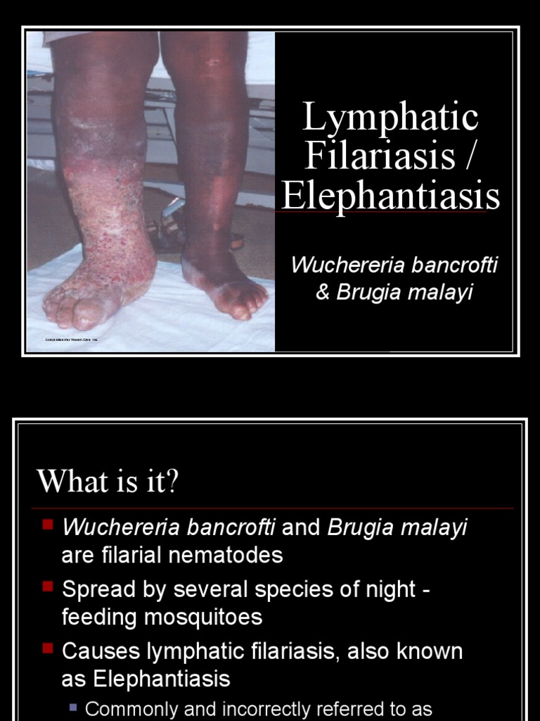 Elephantiasis | PDF | Medicine | Medical Specialties
