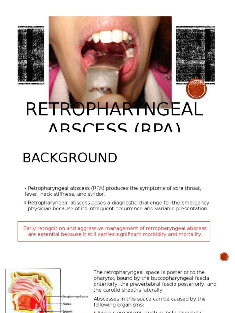Retropharyngeal Abscess (RPA) | PDF | Streptococcus | Sepsis