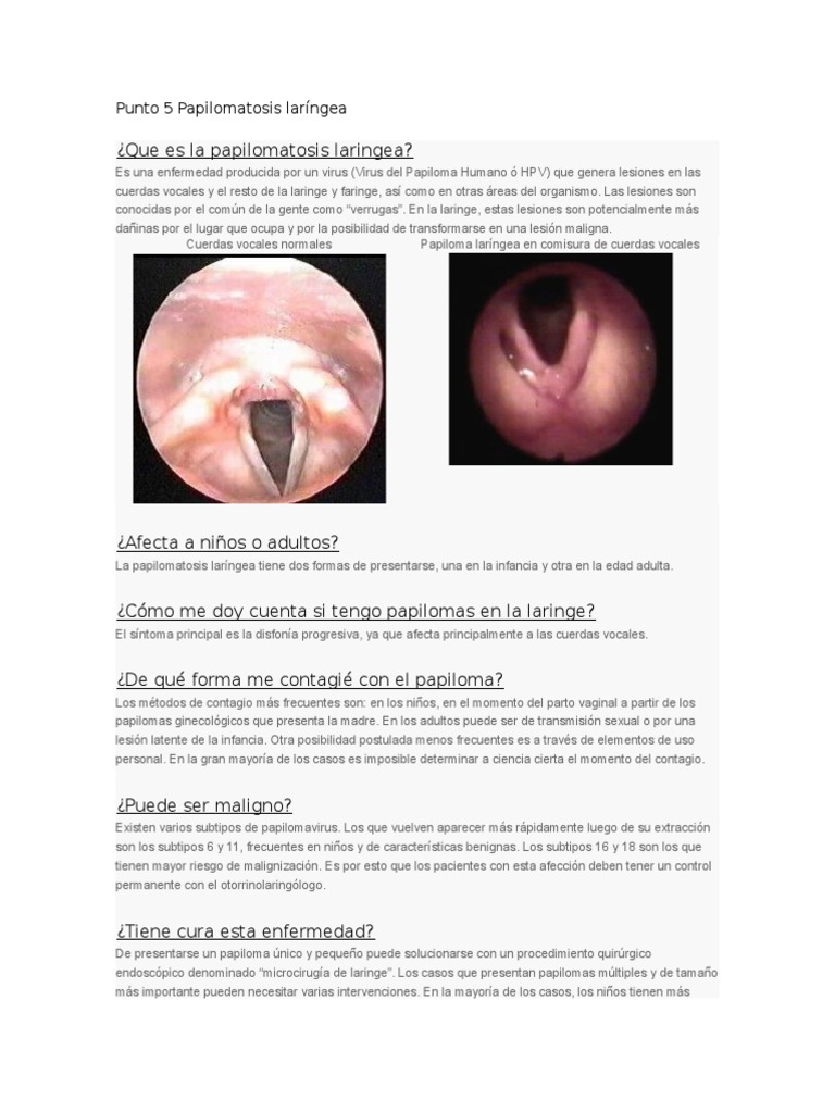 Punto 5 Papilomatosis Laríngea | Rtt | Especialidades Medicas