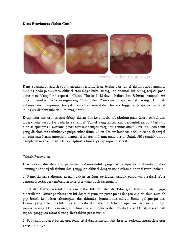 Dens Evaginatus | PDF