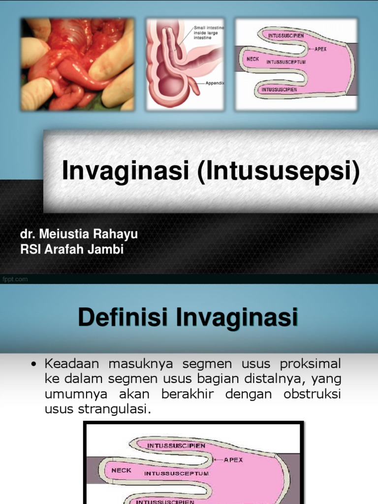 Invaginasi (Intussusepsi) | PDF