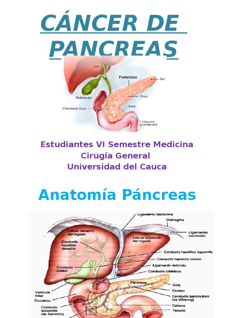 Cáncer de Pancreas | Metástasis | Cáncer