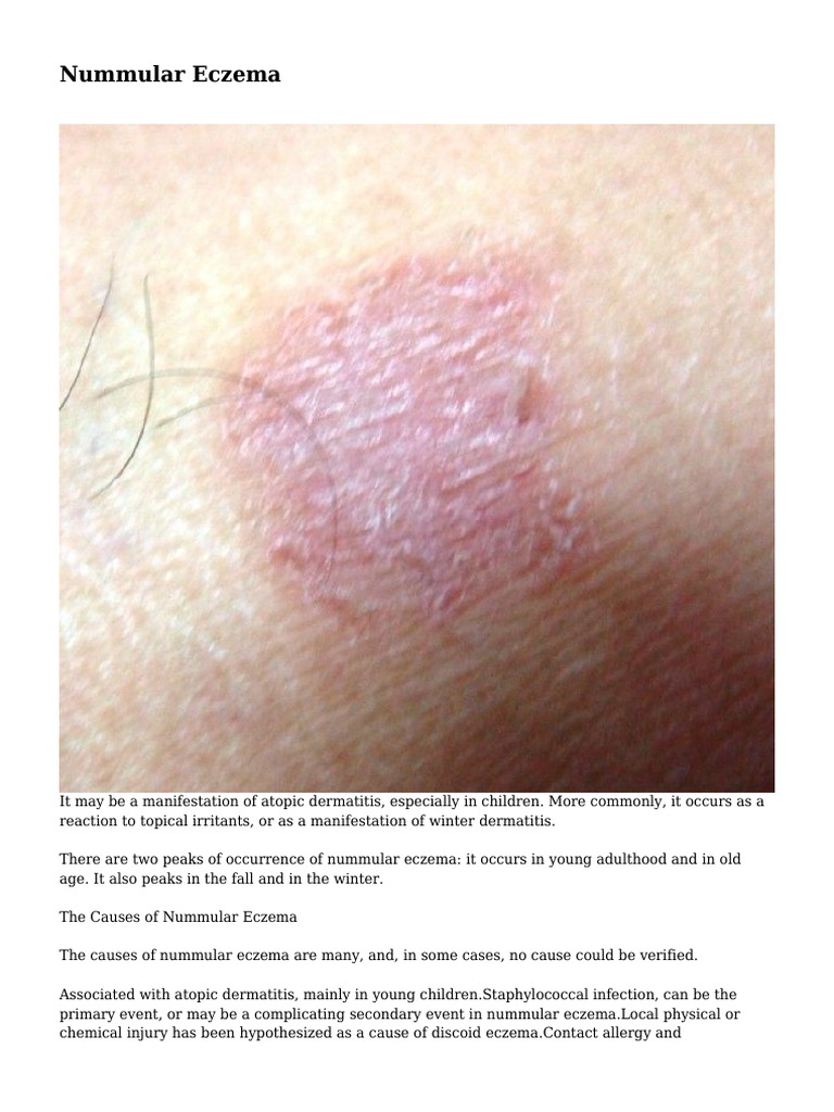 Nummular Eczema | PDF | Dermatitis | Dermatology