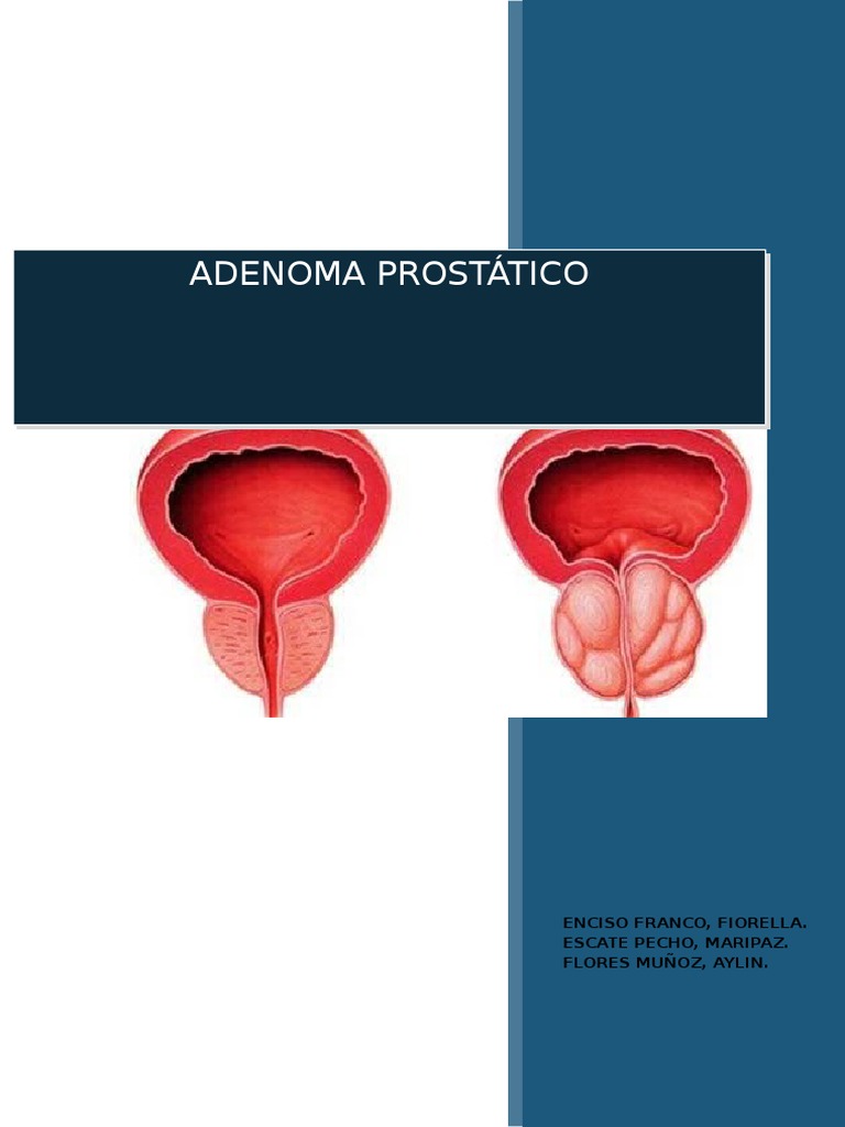 Adenoma Prostático.docx | Cancer de prostata | Urología