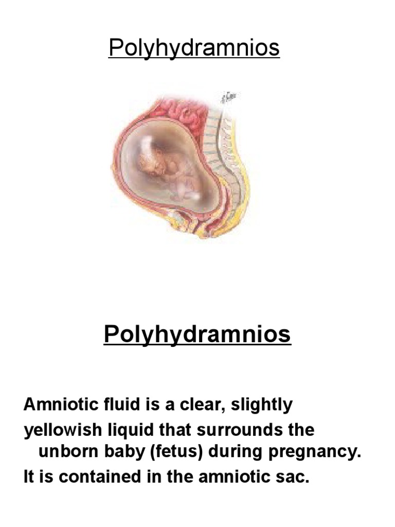 Over Distension of Uterus POLYHYDRAMNIOS | PDF