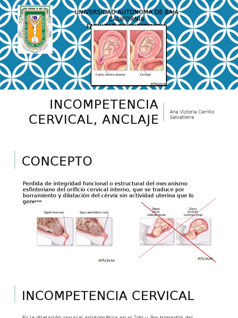 Incompetencia Cervical, Anclaje Avcs | PDF | Parto | Útero