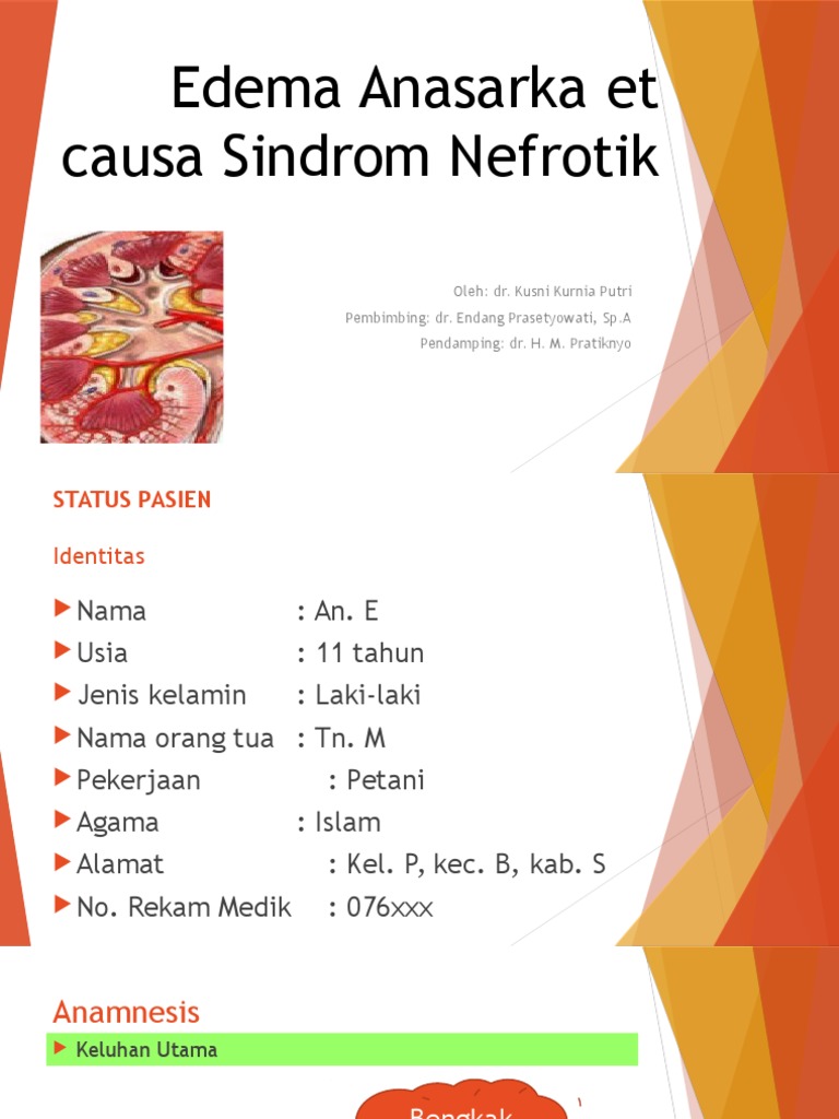 Edema Anasarka Et Causa Sindrom Nefrotik | PDF