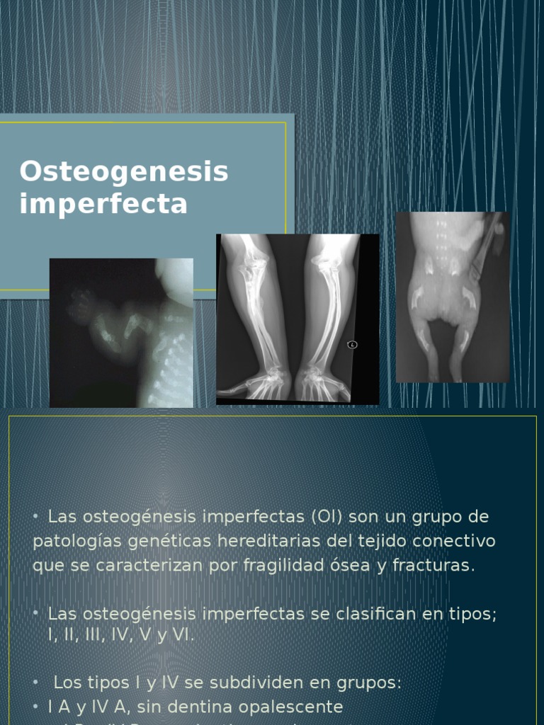Osteogenesis Imperfecta | PDF | Mutación | Hueso