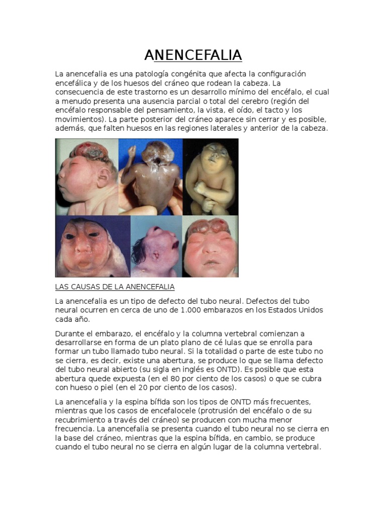 Anencefalia: causas y síntomas | PDF | El embarazo | Especialidades Medicas
