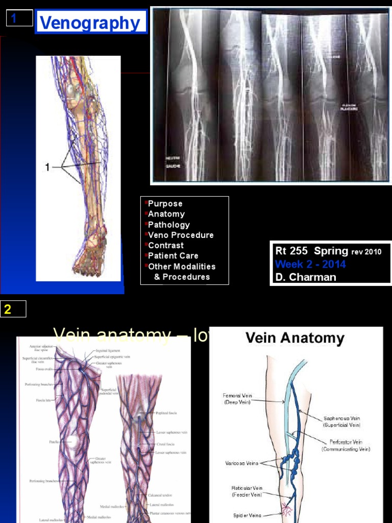 Venography: Rt 255 Spring D. Charman | Thrombosis | Vein | Free 30-day ...