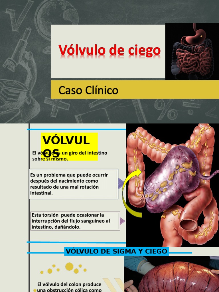 Vólvulo de Ciego | PDF