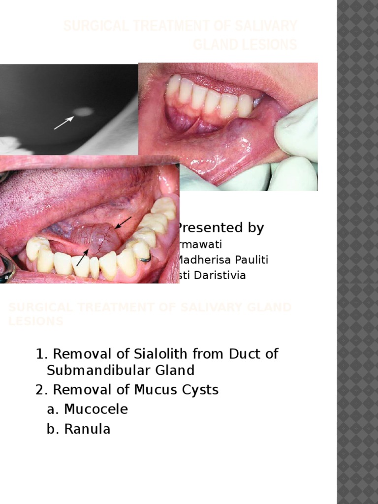 Surgical Treatment of Salivary Gland Lesions: Presented by | PDF ...