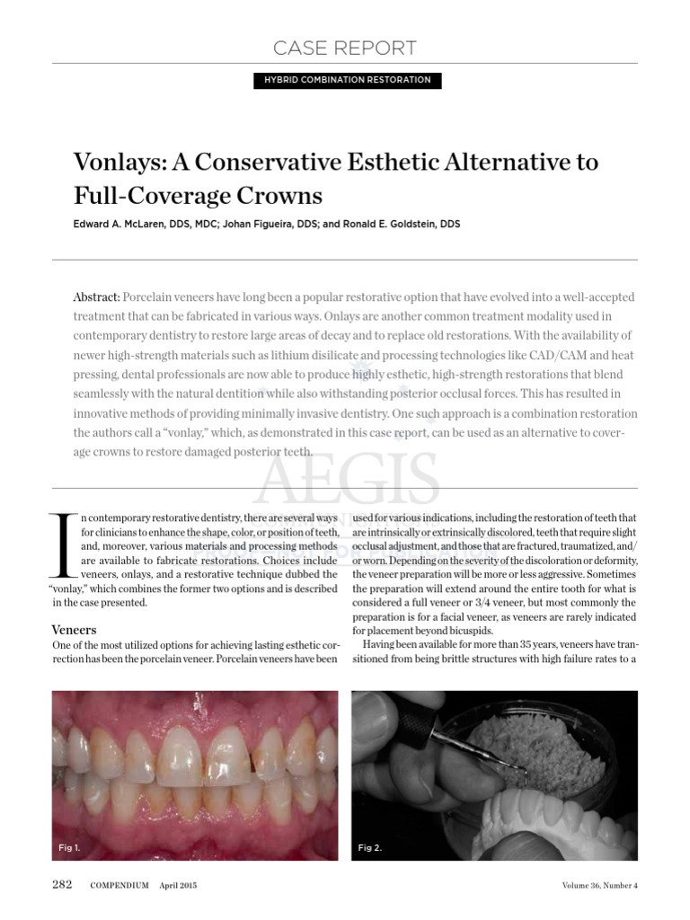 Vonlays: A Conservative Esthetic Alternative To Full-Coverage Crowns ...