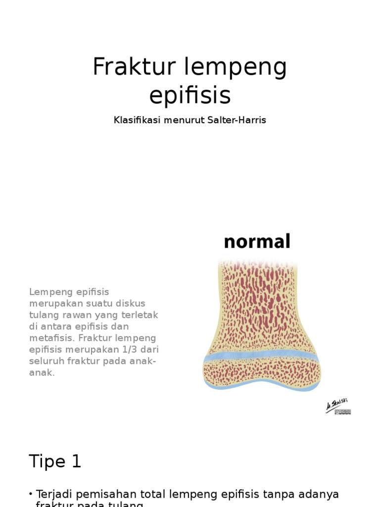 Fraktur Lempeng Epifisis Klasifikasi Salter Dan Haris | PDF
