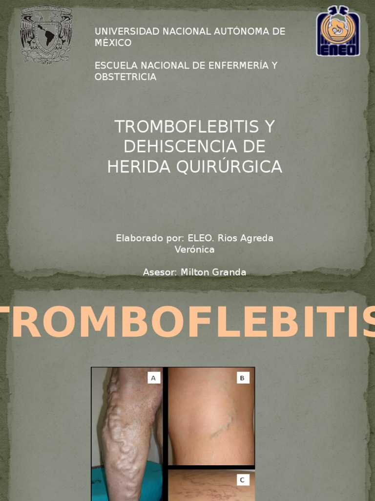Tromboflebitis | PDF | Trombo | Ciencias de la Salud