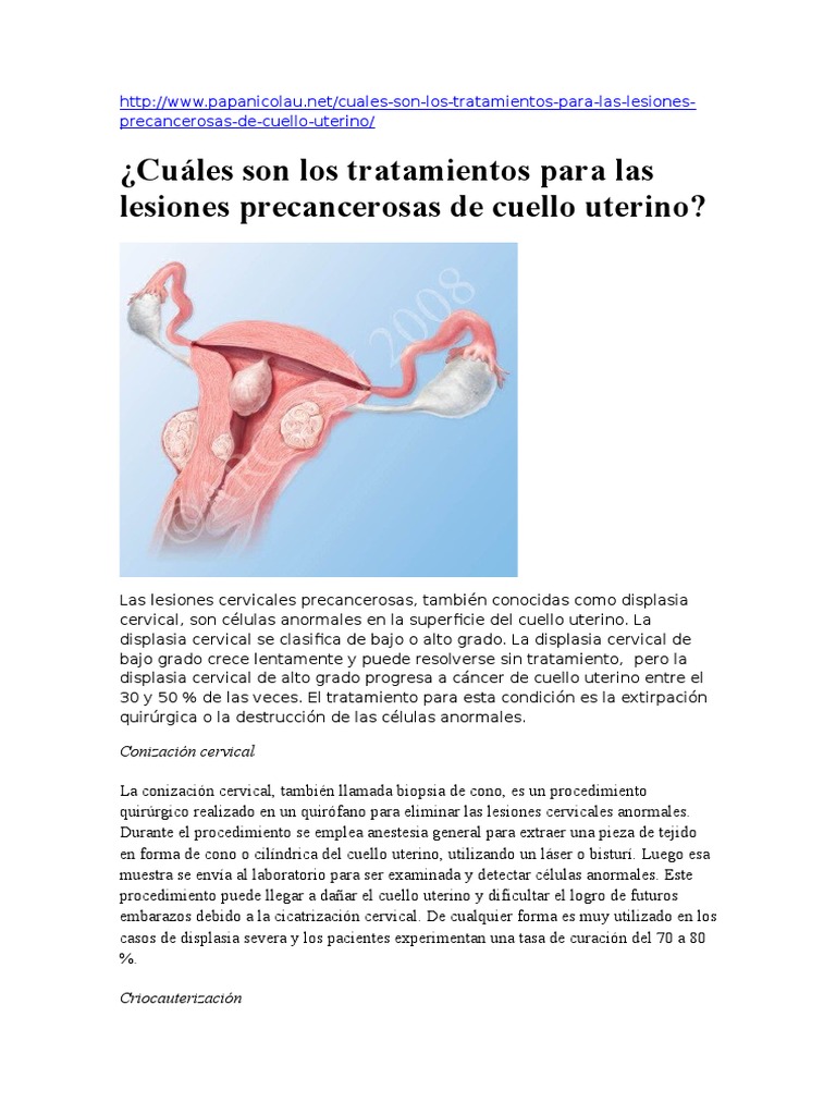 Cuáles Son Los Tratamientos Para Las Lesiones Precancerosas de Cuello Uterino | Cáncer de cuello ...