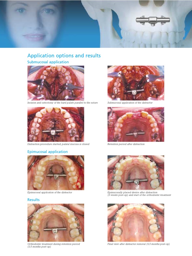 Palatal Distractor | Screw | Dentistry Branches