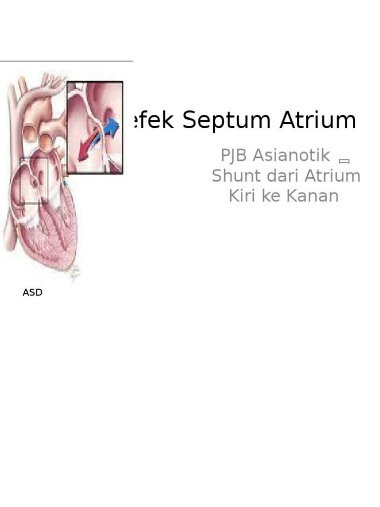 Defek Septum Atrium: PJB Asianotik Shunt Dari Atrium Kiri Ke Kanan ...