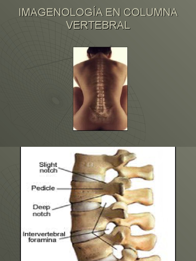 Imagenologia en Columna Vertebral 101215230221 Phpapp01 | PDF | Escoliosis | Vértebra
