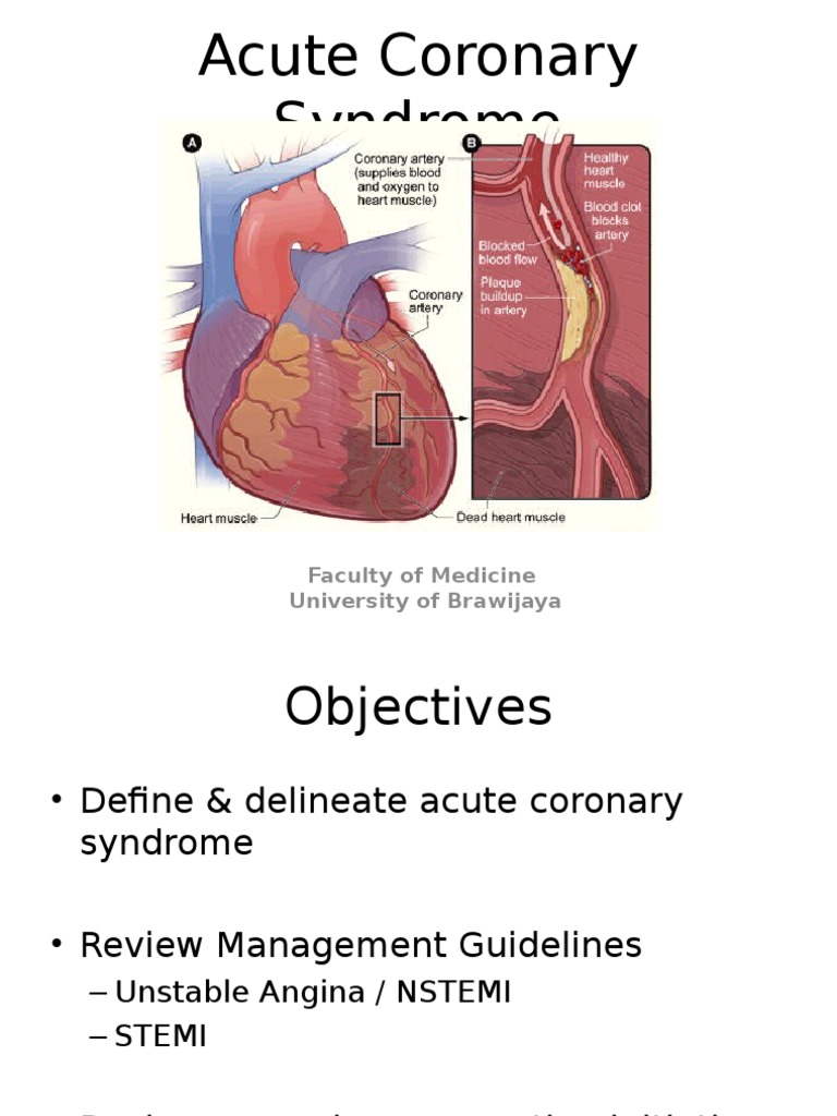 ACS lecture | Myocardial Infarction | Angina Pectoris